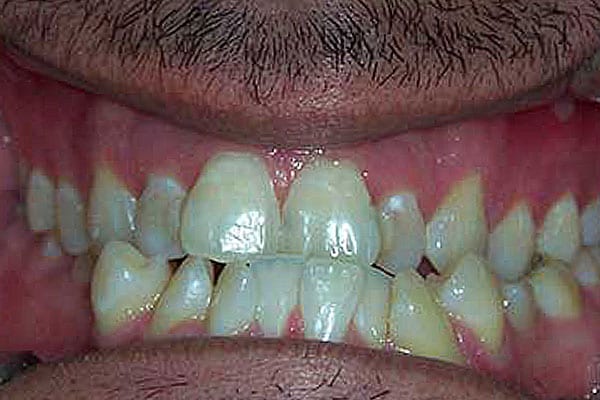 Crossbite Treatment in Glen & Mt Waverley | Waverley Orthodontics